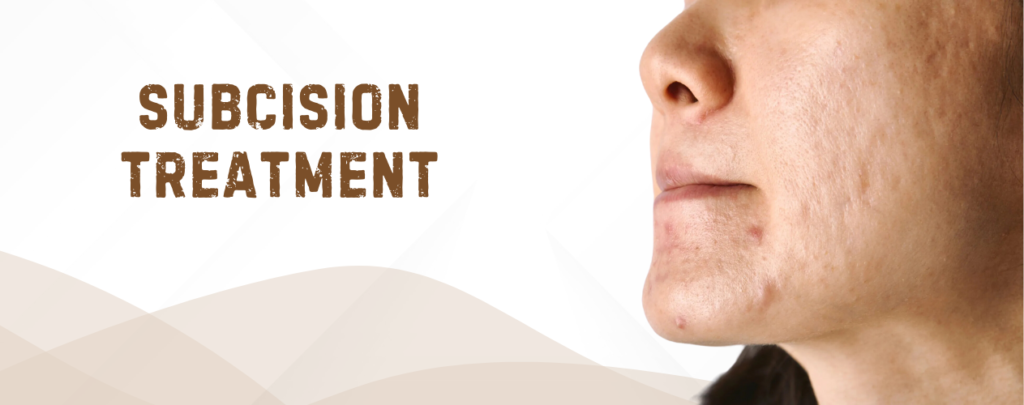 Subcision – drpratikshivhare.com