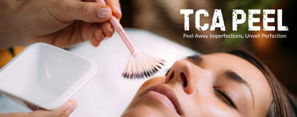 TCA peel – drpratikshivhare.com